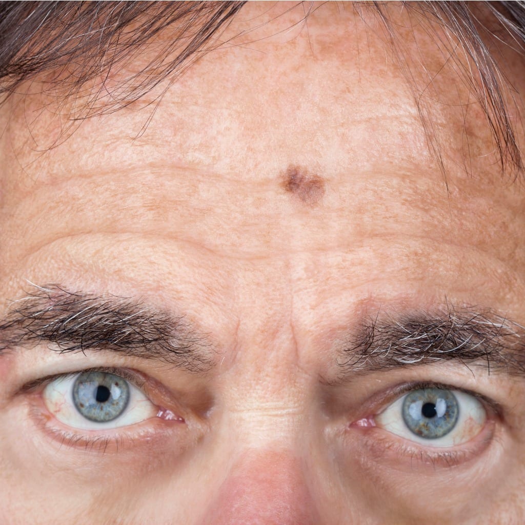 Melanoma Skin Cancer Spots On Face